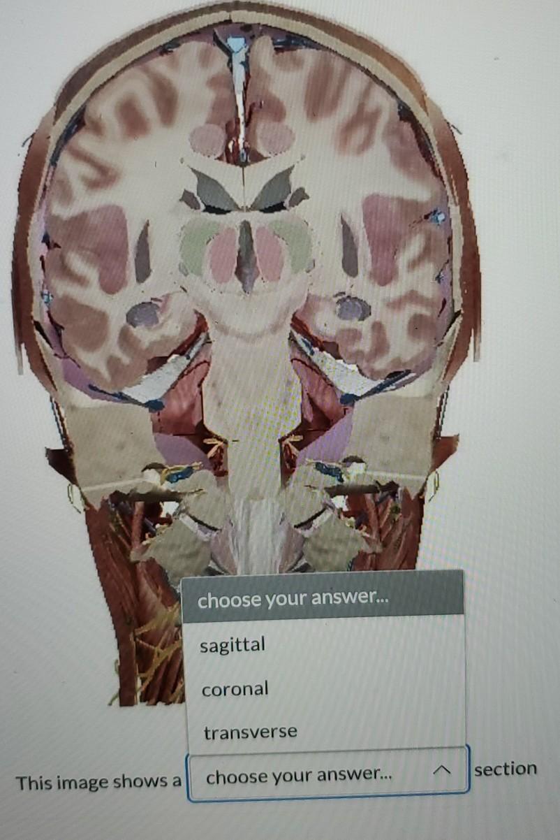 Solved VO choose your answer... sagittal coronal transverse | Chegg.com
