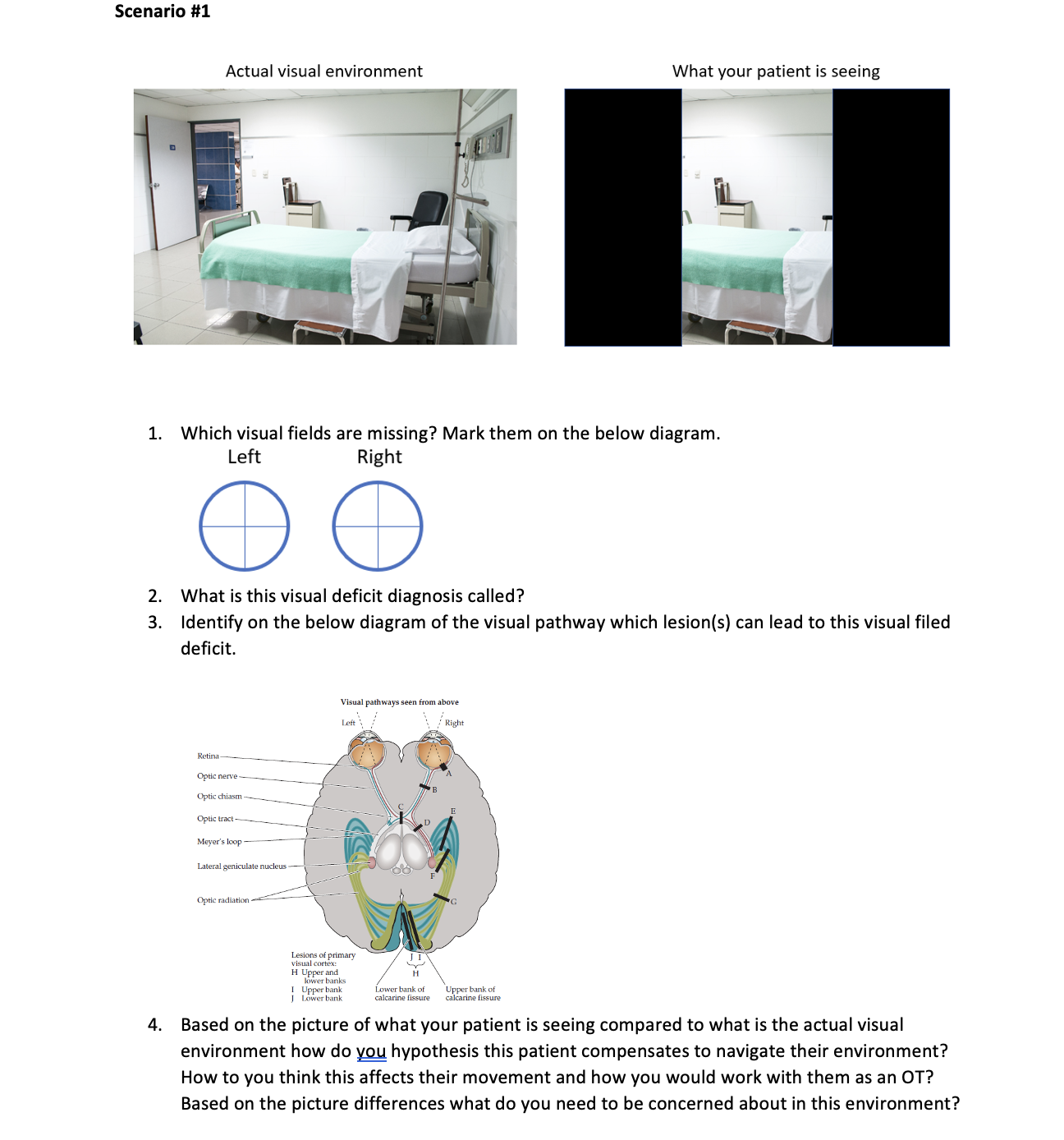 Solved Which visual fields are missing? Mark them on the | Chegg.com