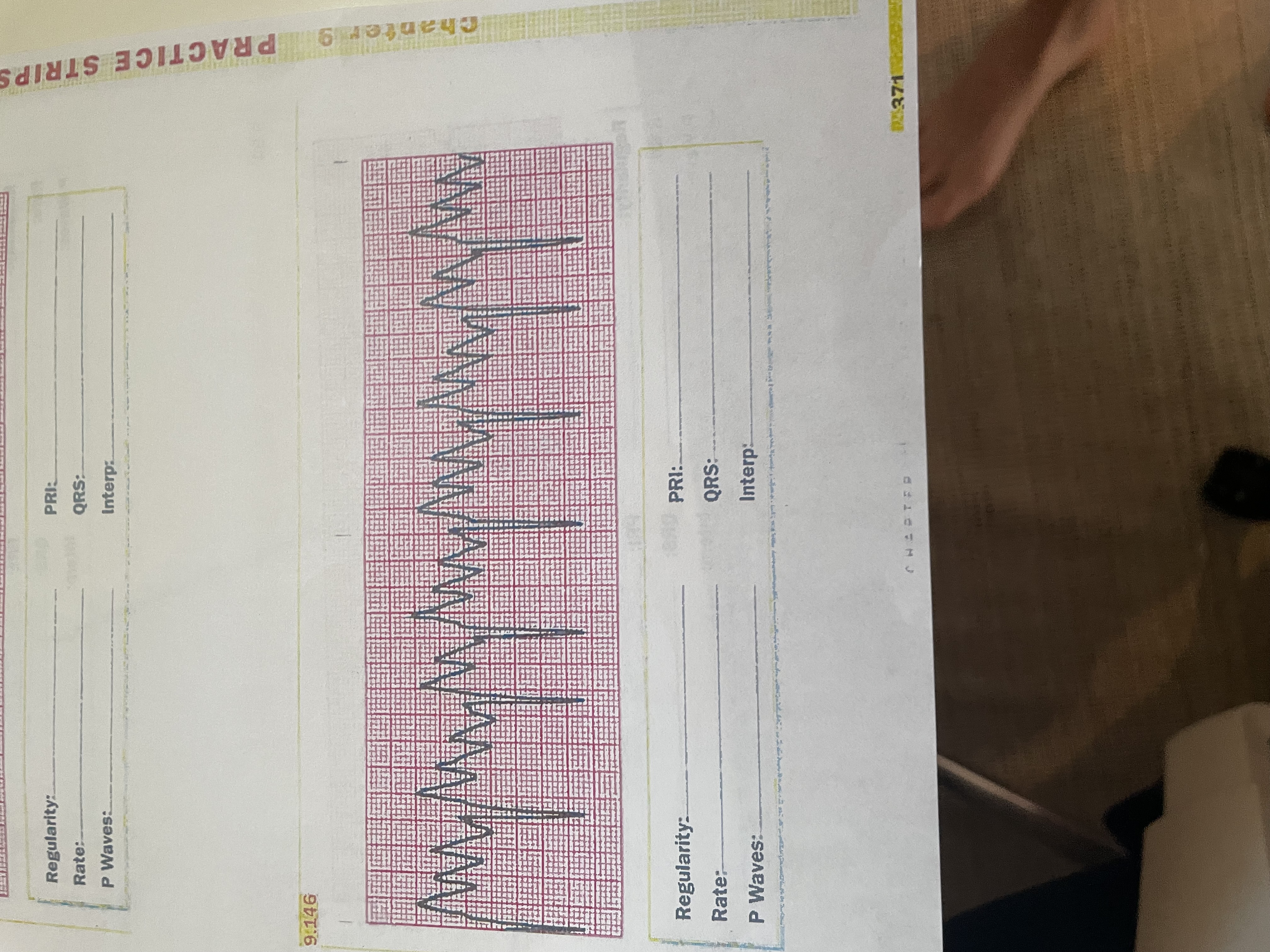 Solved what is this heart rhythym and the intervals? | Chegg.com