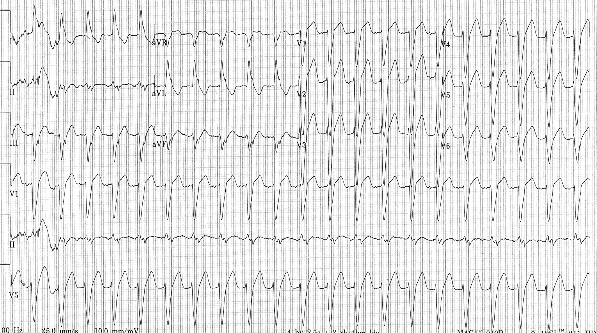 Solved Is this ventricular tachycardia or atrial | Chegg.com