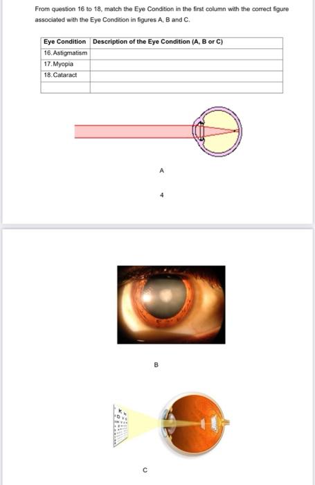 Solved From question 16 to 18, match the Eye Condition in | Chegg.com