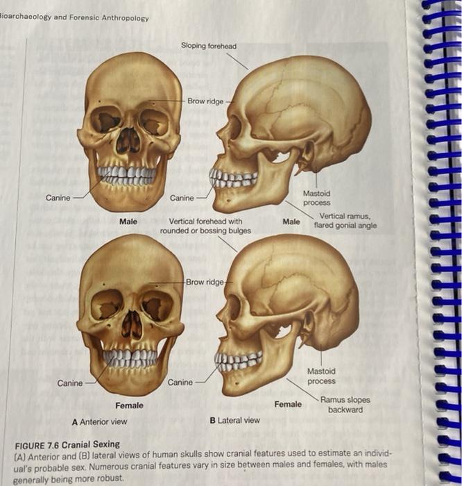 Solved Bioarchaeology and Forensic Anthropology Sloping | Chegg.com