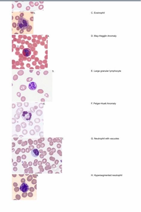 Solved C. Eosinophi D. May-Hegglin Anomaly Large grande | Chegg.com