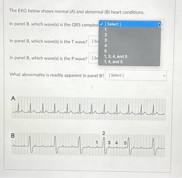 Solved The EKG below shows normal (A) and abnormal (B) heart | Chegg.com