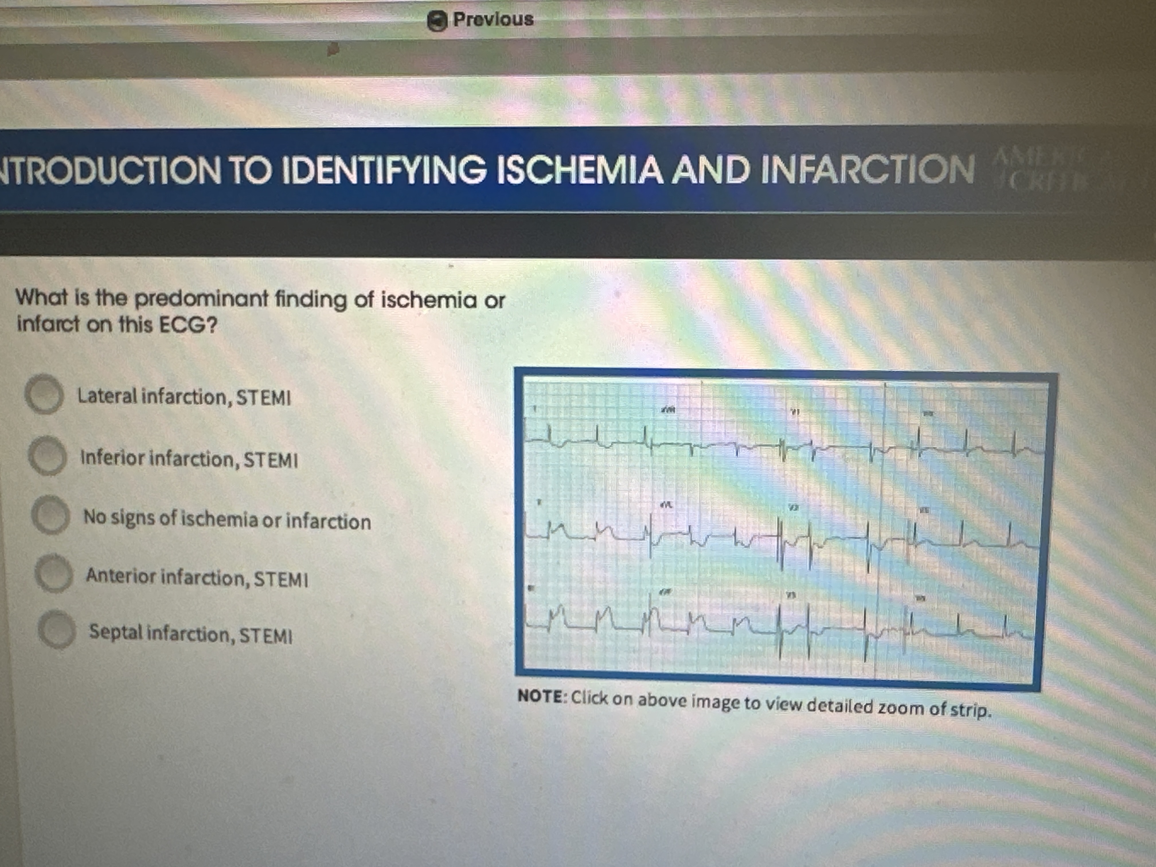 Solved PreviousITRODUCTION TO IDENTIFYING ISCHEMIA AND | Chegg.com