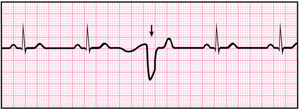 Solved Describe any abnormalities you notice with this ECG. | Chegg.com