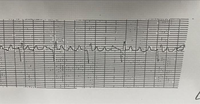 Solved What is the ventricular rate of the ECG strip | Chegg.com