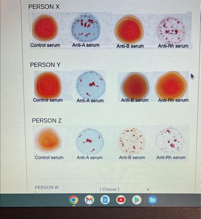 Solved Match the blood typing results below to the correct | Chegg.com