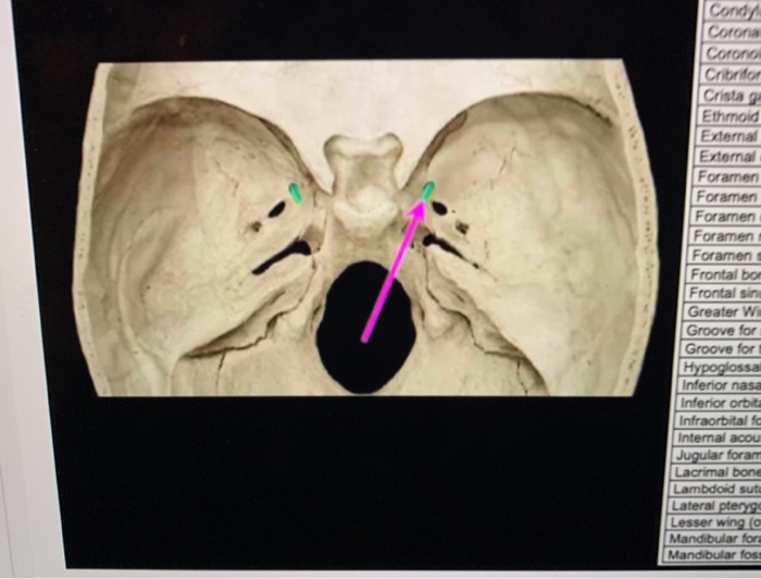 Solved Condy (Corona Coronol Cribitor Crista Ethmoid | Chegg.com