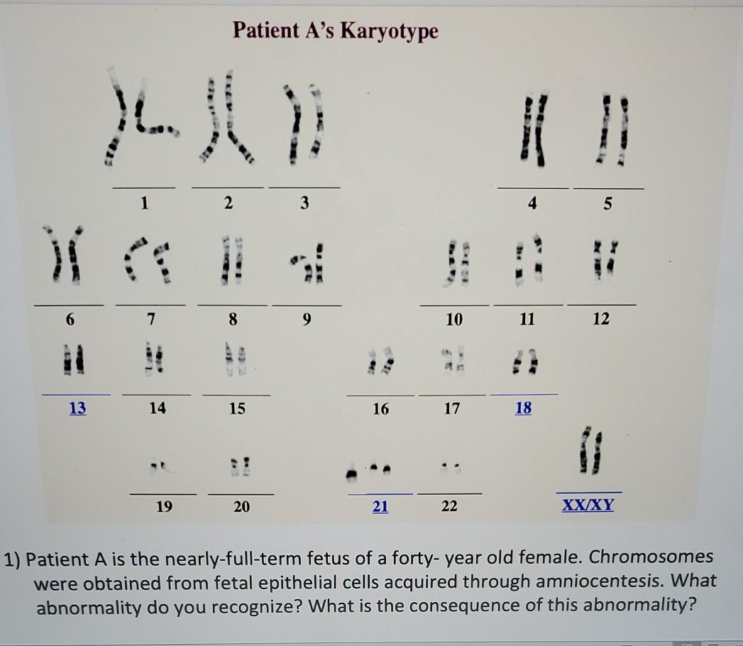Solved Patient A's Karyotype 1 2 3 4 5 6 7 8 9 10 11 12 13 | Chegg.com