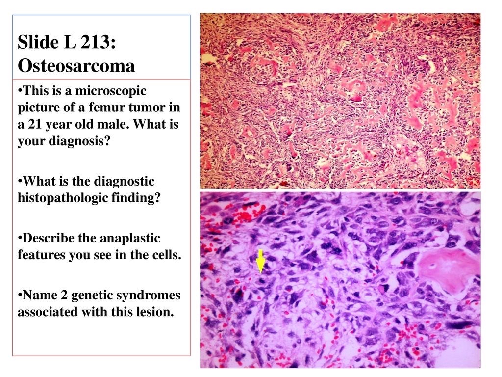 Solved Slide L 213:Osteosarcoma-This is a microscopic | Chegg.com