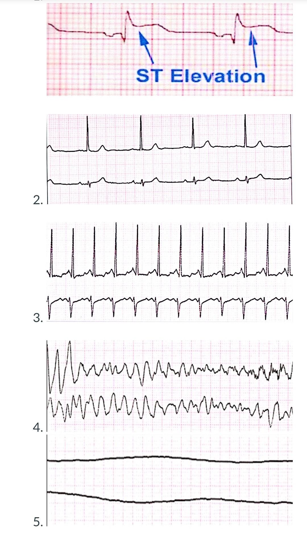 Solved please identify the type of abnormality on each ECG | Chegg.com