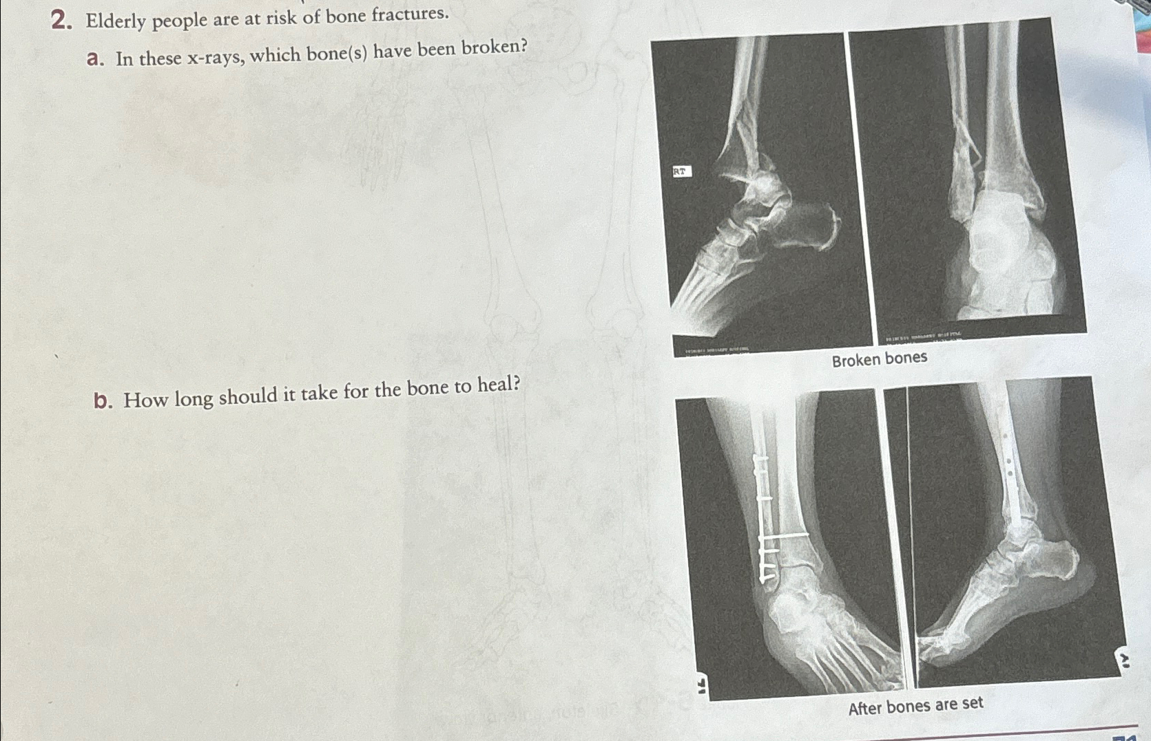 Solved Elderly people are at risk of bone fractures.a. ﻿In | Chegg.com