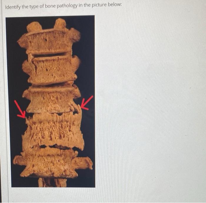 Solved Identify the type of bone pathology in the picture | Chegg.com