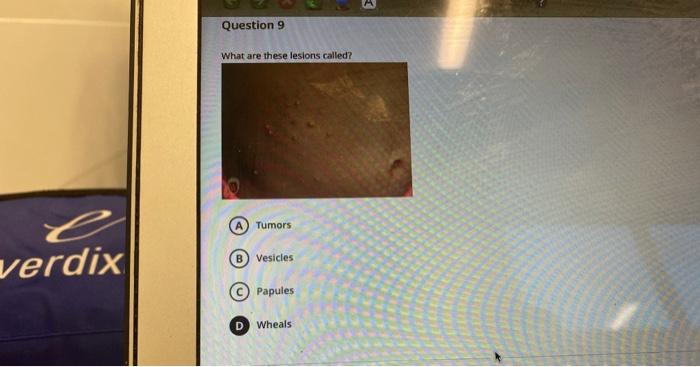 Solved What is this lesion called? Vesicle Wheal | Chegg.com