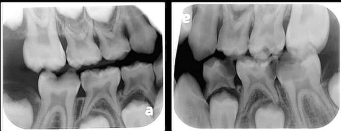 Solved classify these tooth in carries radiographic | Chegg.com
