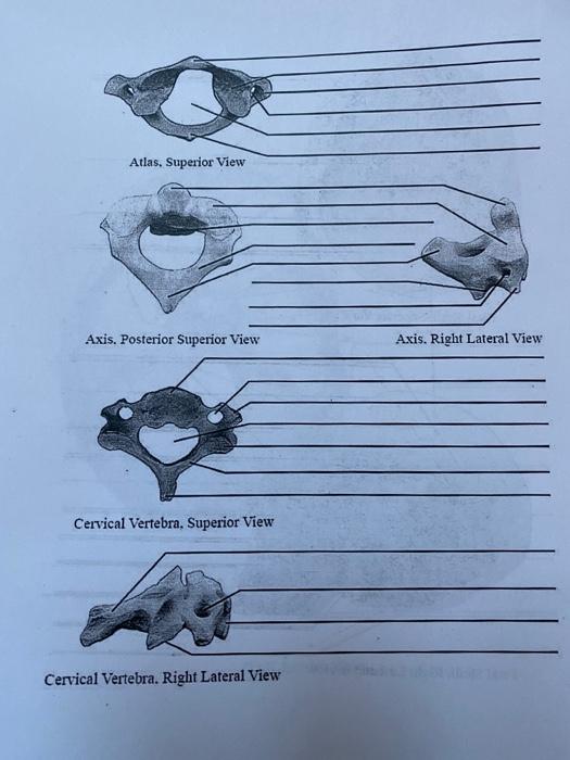 Axis Vertebra Superior View