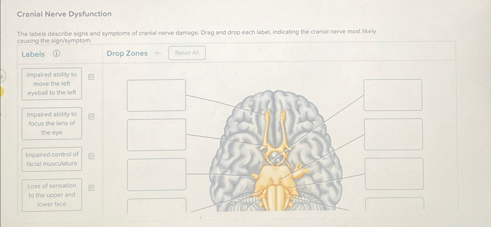 Solved Cranial Nerve DysfunctionThe labels describe signs | Chegg.com