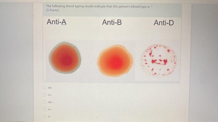 Solved The following blood typing results indicate that this | Chegg.com