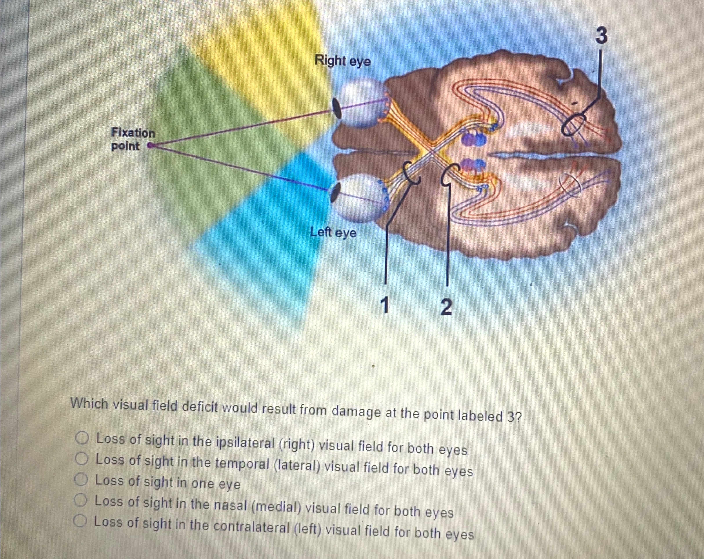 Solved Which visual field deficit would result from damage | Chegg.com