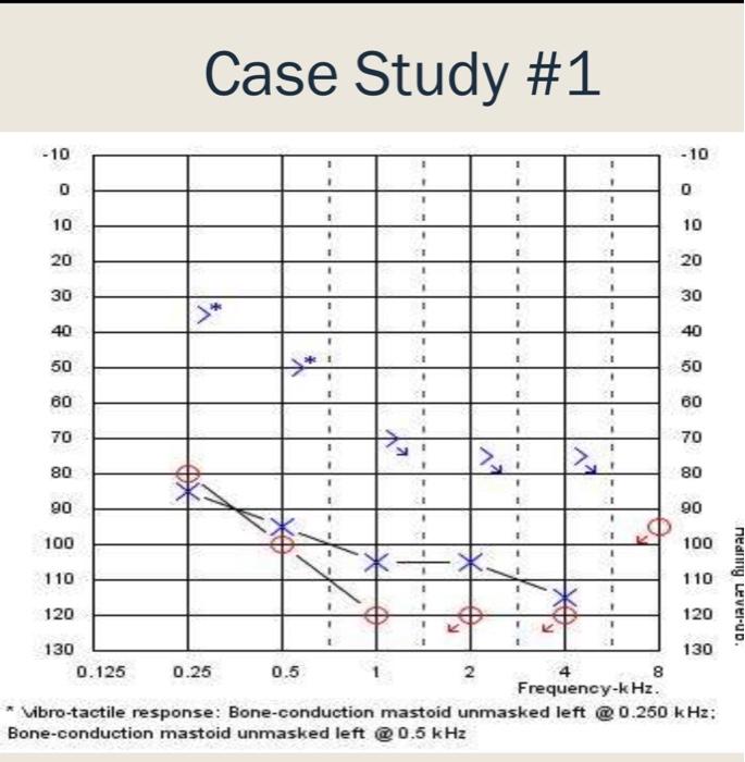 Profound Sensorineural Hearing Loss Audiogram