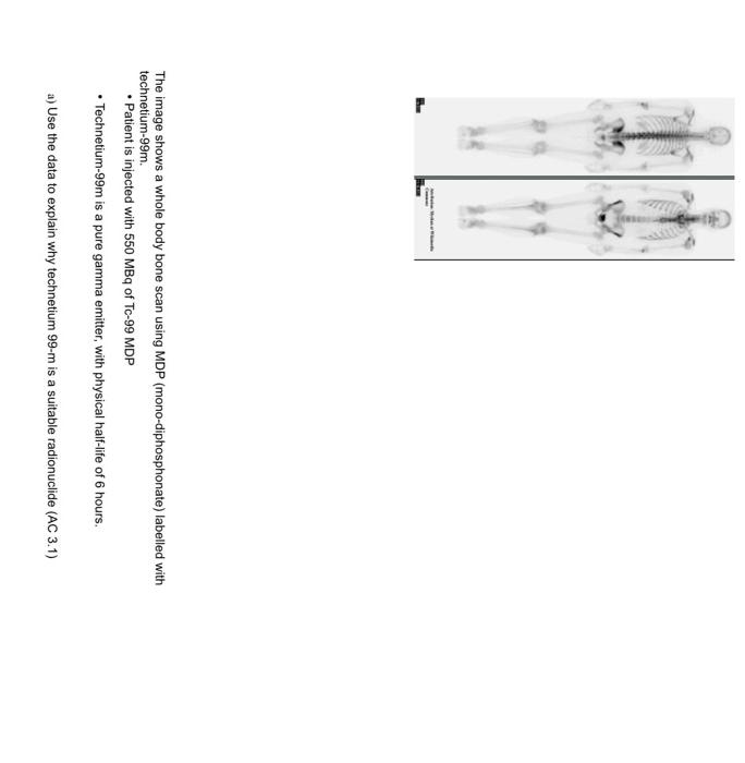 Solved The image shows a whole body bone scan using MDP | Chegg.com