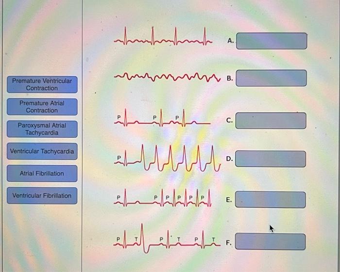Solved Label the following images that illustrate the EKGs | Chegg.com