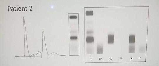 Normal Control Densitometry Trace SPEP Immunofixation | Chegg.com