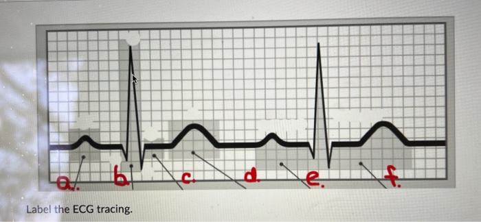 Solved Label the ECG tracing. Label the ECG tracing. e. 1. | Chegg.com