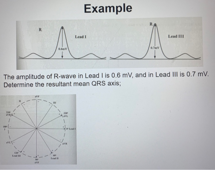 Solved Example Lead I Lead III The amplitude of R-wave in | Chegg.com