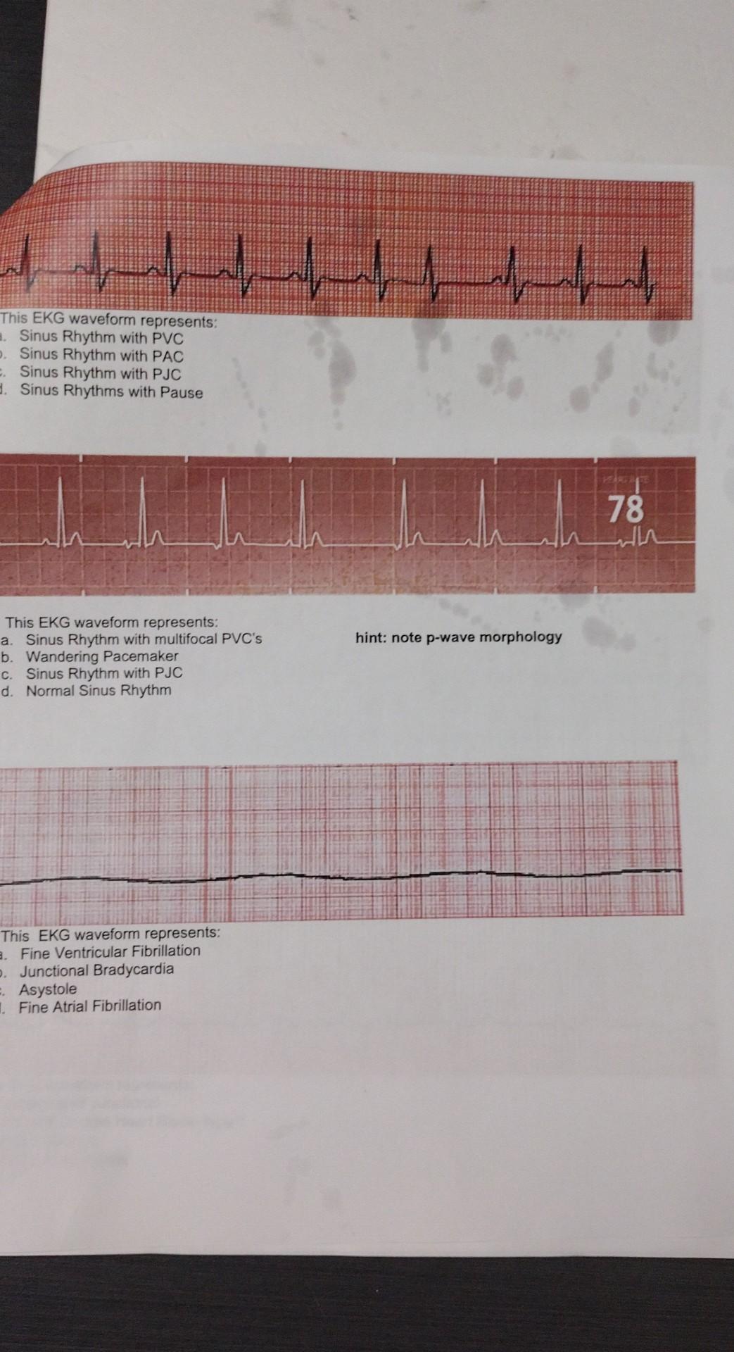 Solved التالي الله الله الله الي السر الي الله This EKG | Chegg.com