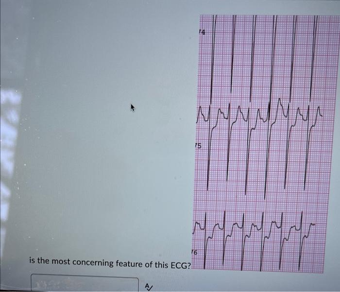 Solved This ECG was recorded at peak exercise in a patient | Chegg.com