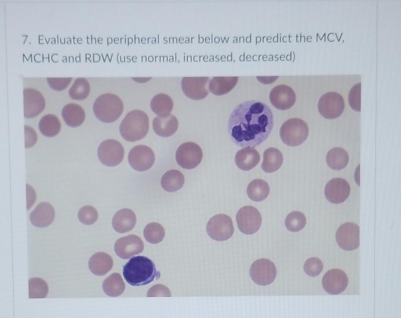 Solved 7. Evaluate the peripheral smear below and predict | Chegg.com