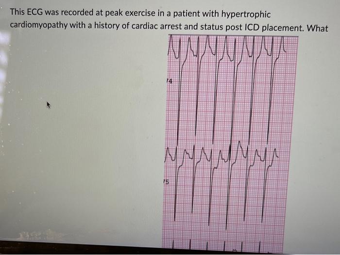 Solved This ECG was recorded at peak exercise in a patient | Chegg.com