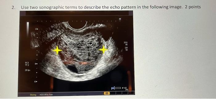 Solved sonography terms: anechoic, complex, echogenic, | Chegg.com