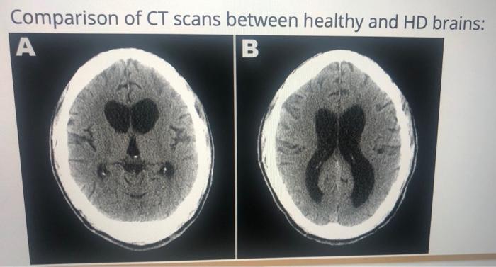 Solved Comparison of CT scans between healthy and HD brains: | Chegg.com