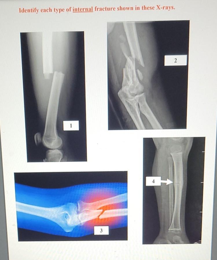 Solved Identify each type of internal fracture shown in | Chegg.com