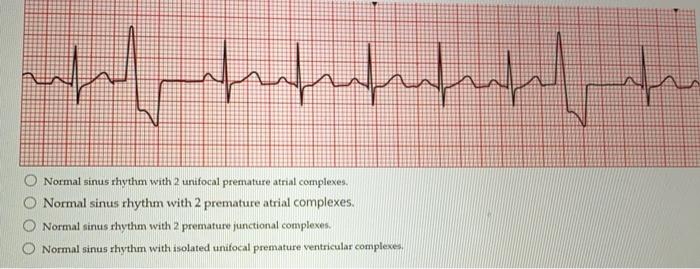 Solved Question Text u u n accelerated idioventricular | Chegg.com