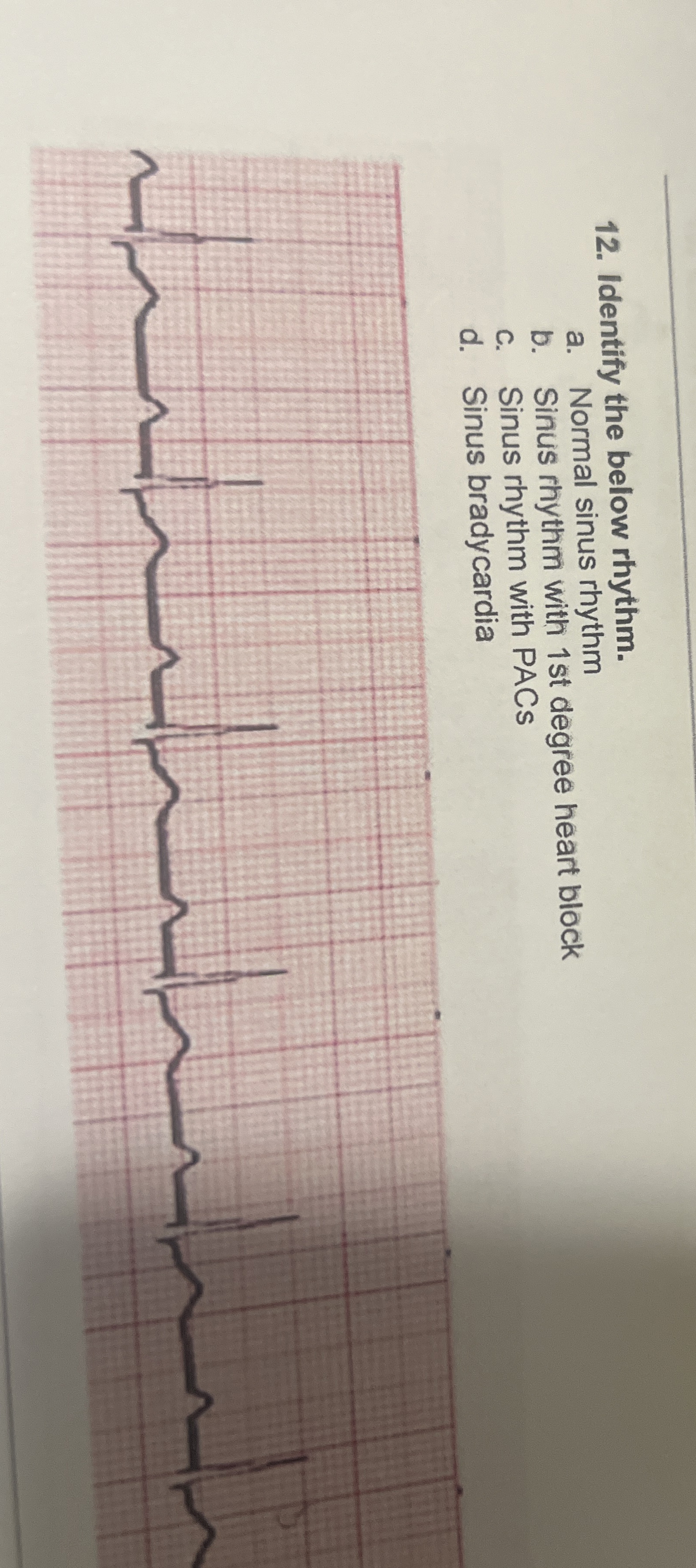 Solved Identify the below rhythm.a. Normal sinus rhythmb. | Chegg.com Solved Identify the below rhythm.a. Normal sinus rhythmb. | Chegg.com