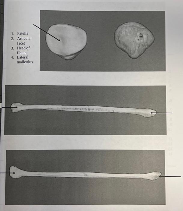 1. Patella 2. Articular facet 3. Head of fibula 4. | Chegg.com