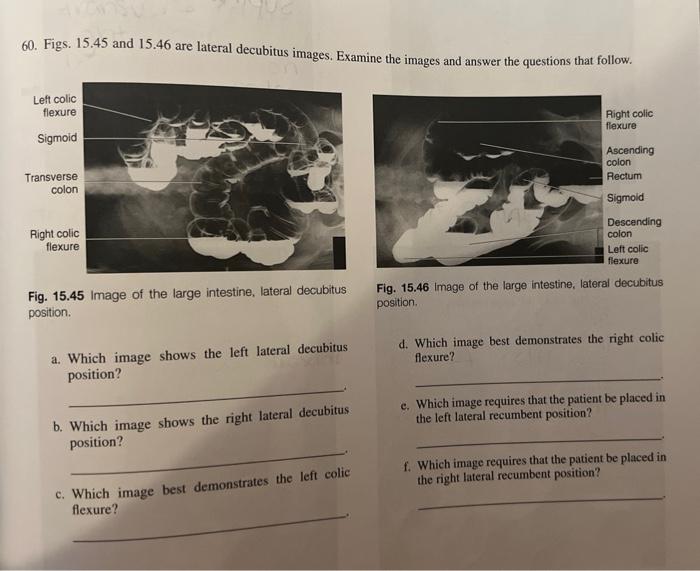 Left Lateral Decubitus Position