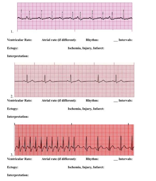 Solved 1 Ventricular Rate Ectopy Interpretation 2