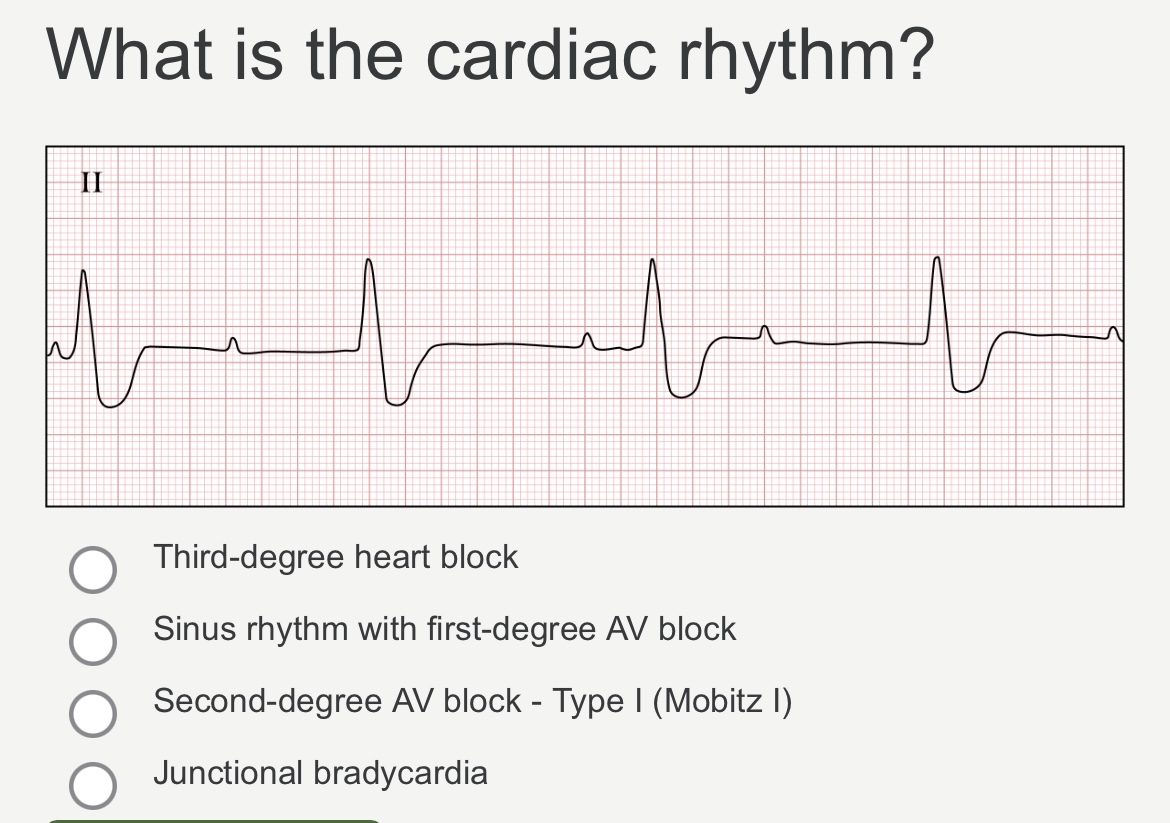 Solved What is the Cardia Rhythm shown in the EKG strip | Chegg.com