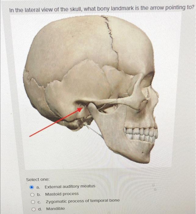 Solved In the lateral view of the skull, what bony landmark | Chegg.com