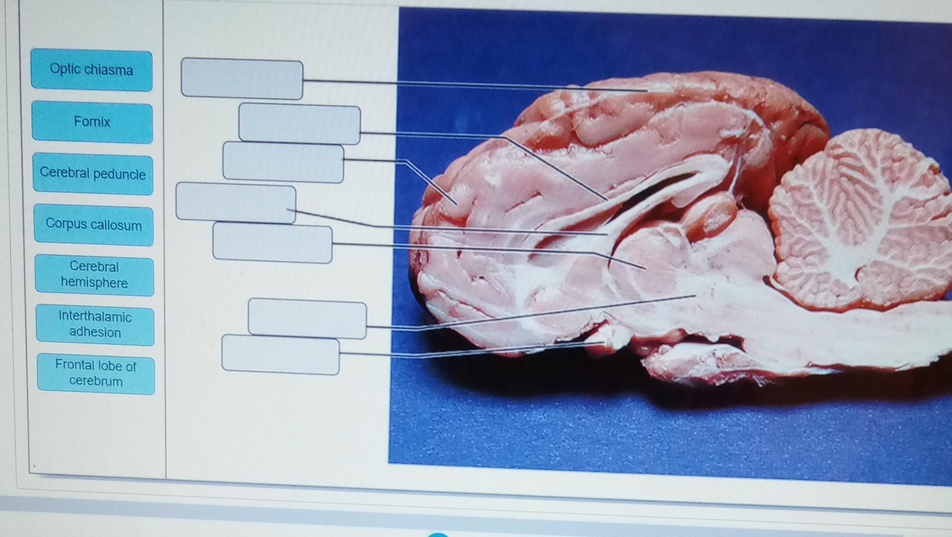 Interthalamic Adhesion Sheep Brain