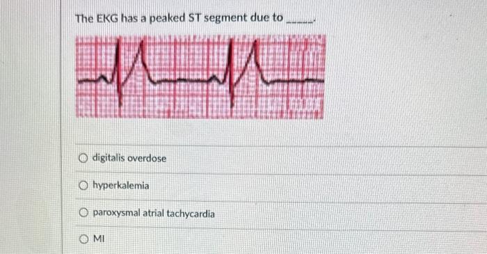 Solved The EKG has a peaked ST segment due to digitalis | Chegg.com