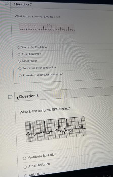 Solved What is this abnormal EKG tracing? Ventricular | Chegg.com