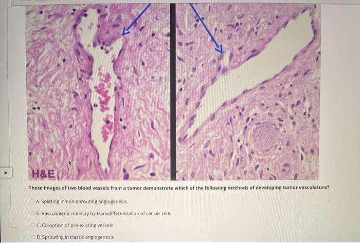 Solved H&E These images of two blood vessels from a tumor | Chegg.com