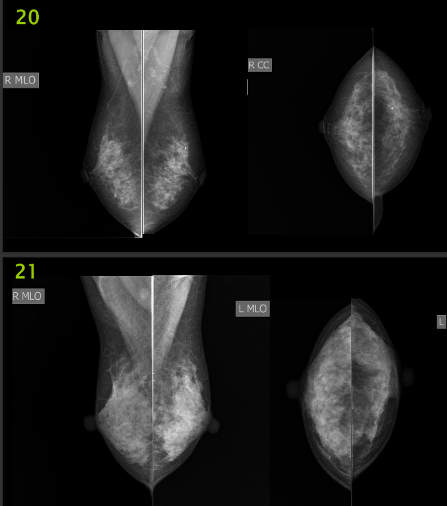 Solved the image below are mammography images please | Chegg.com
