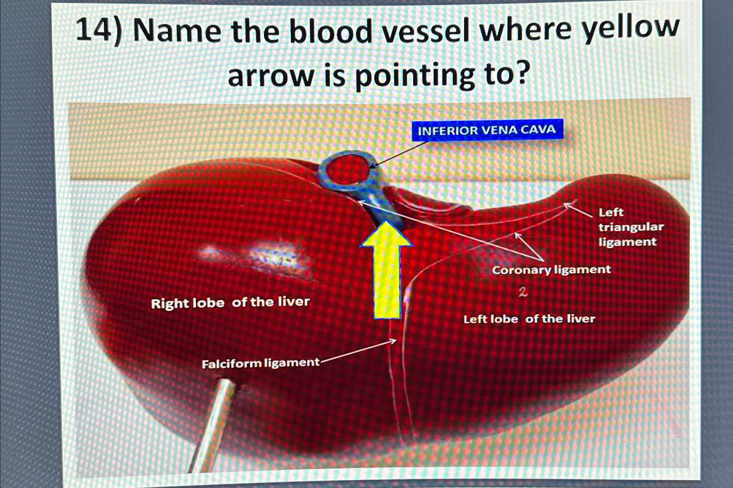 Solved Name the blood vessel where yellow arrow is pointing | Chegg.com